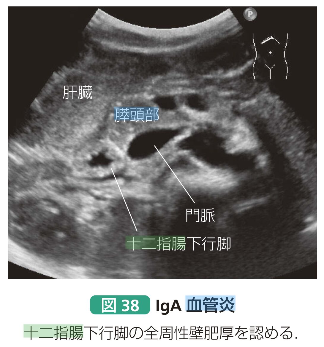 【猿でもわかる】IgA血管炎 - Dr.Tigerの猿note〜猿でもわかるこども診療のトリセツ〜